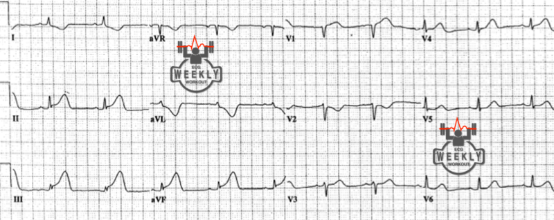 Atrial Septal Defect (ASD) & Crochetage Pattern – ECG Weekly