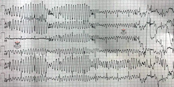 Atrial Septal Defect (ASD) & Crochetage Pattern – ECG Weekly