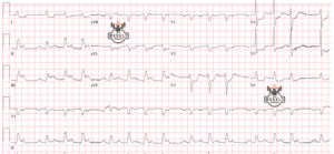 ECG Weekly – Learn ECGs One Week at a Time