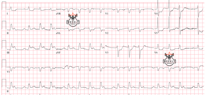 Atrial Septal Defect (ASD) & Crochetage Pattern – ECG Weekly