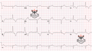 Atrial Septal Defect (ASD) & Crochetage Pattern – ECG Weekly