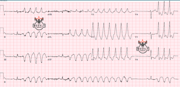 Atrial Septal Defect (ASD) & Crochetage Pattern – ECG Weekly