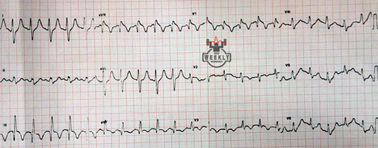 Atrial Septal Defect (ASD) & Crochetage Pattern – ECG Weekly