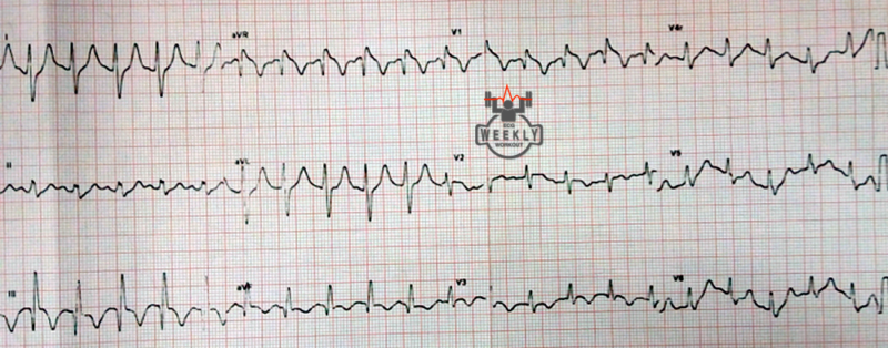 Atrial Septal Defect (ASD) & Crochetage Pattern – ECG Weekly