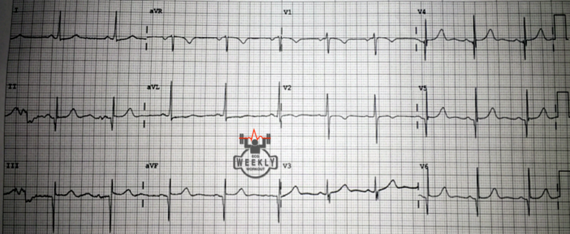 Atrial Septal Defect (ASD) & Crochetage Pattern – ECG Weekly