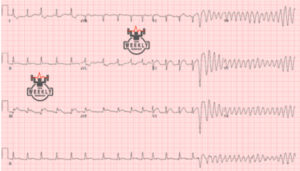 ECG Weekly – Learn ECGs One Week at a Time