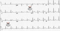 ECG Weekly – Learn ECGs One Week at a Time