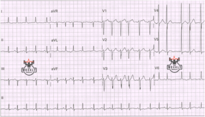 ECG Weekly – Learn ECGs One Week at a Time