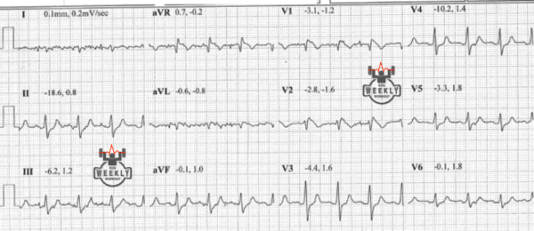 ECG Weekly – Learn ECGs One Week at a Time