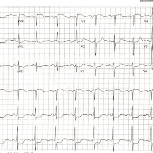 Aortic Dissection – ECG Weekly