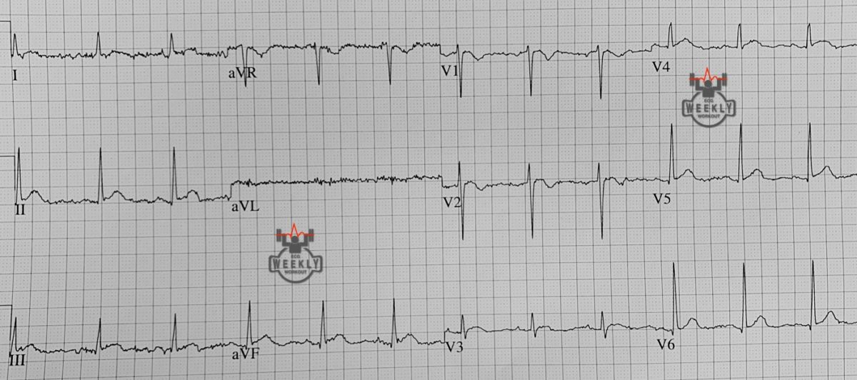 Hypercalcemia – ECG Weekly
