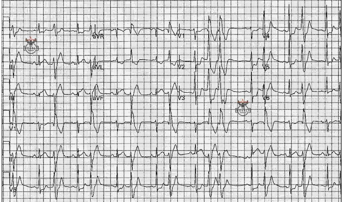 Tremor artifact – ECG Weekly