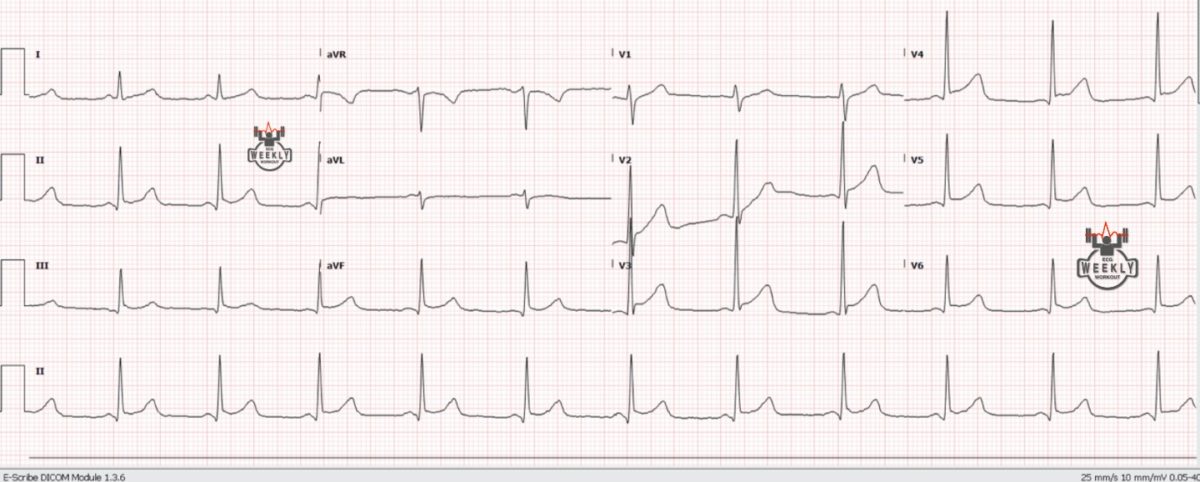 Terminal QRS distortion – ECG Weekly