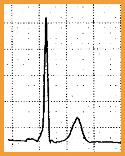 ECG Weekly – Learn ECGs One Week at a Time