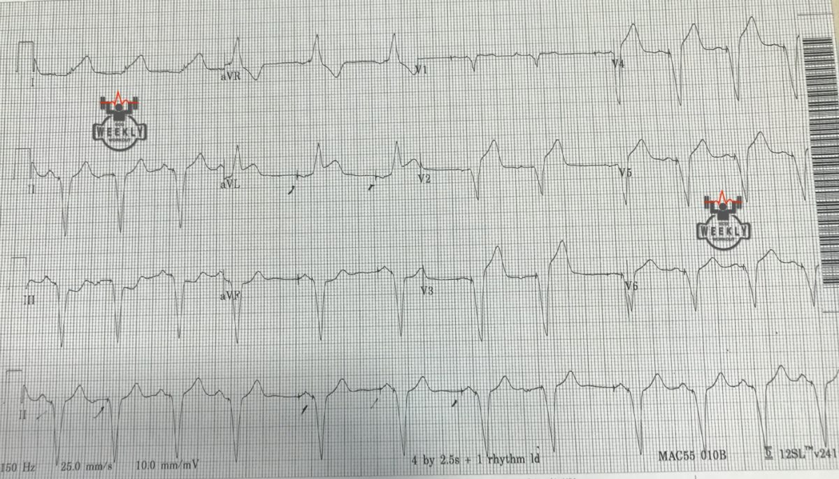 Sgarbossa Criteria – ECG Weekly