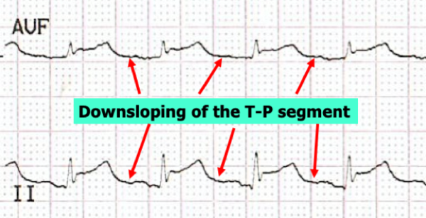 ECG Weekly – Learn ECGs One Week at a Time