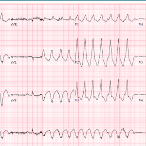 Ventricular rhythms – ECG Weekly