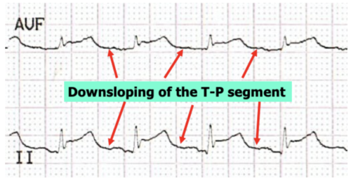 ECG Weekly – Learn ECGs One Week at a Time
