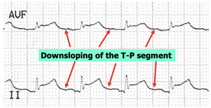 ECG Weekly – Learn ECGs One Week at a Time