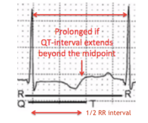 Long QT interval DDx – ECG Weekly