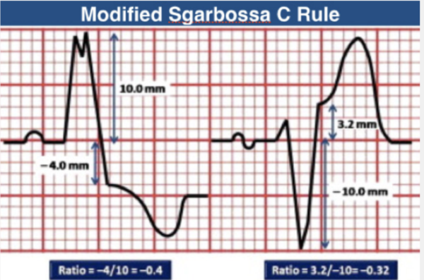 MODIFIED SGARBOSSA CRITERIA – ECG Weekly