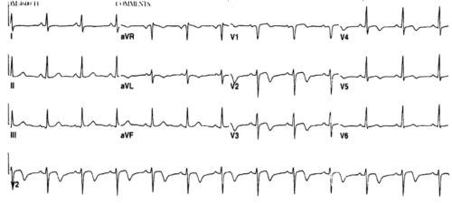 Wellens Waves – ECG Weekly