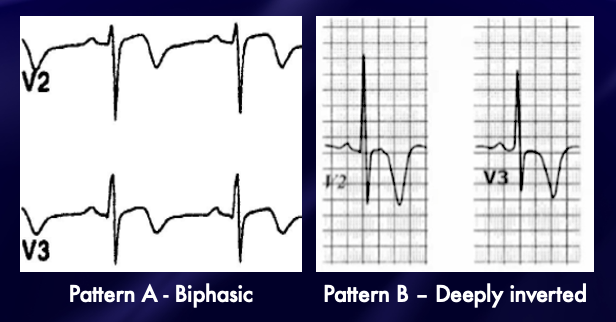 Wellens Waves – ECG Weekly