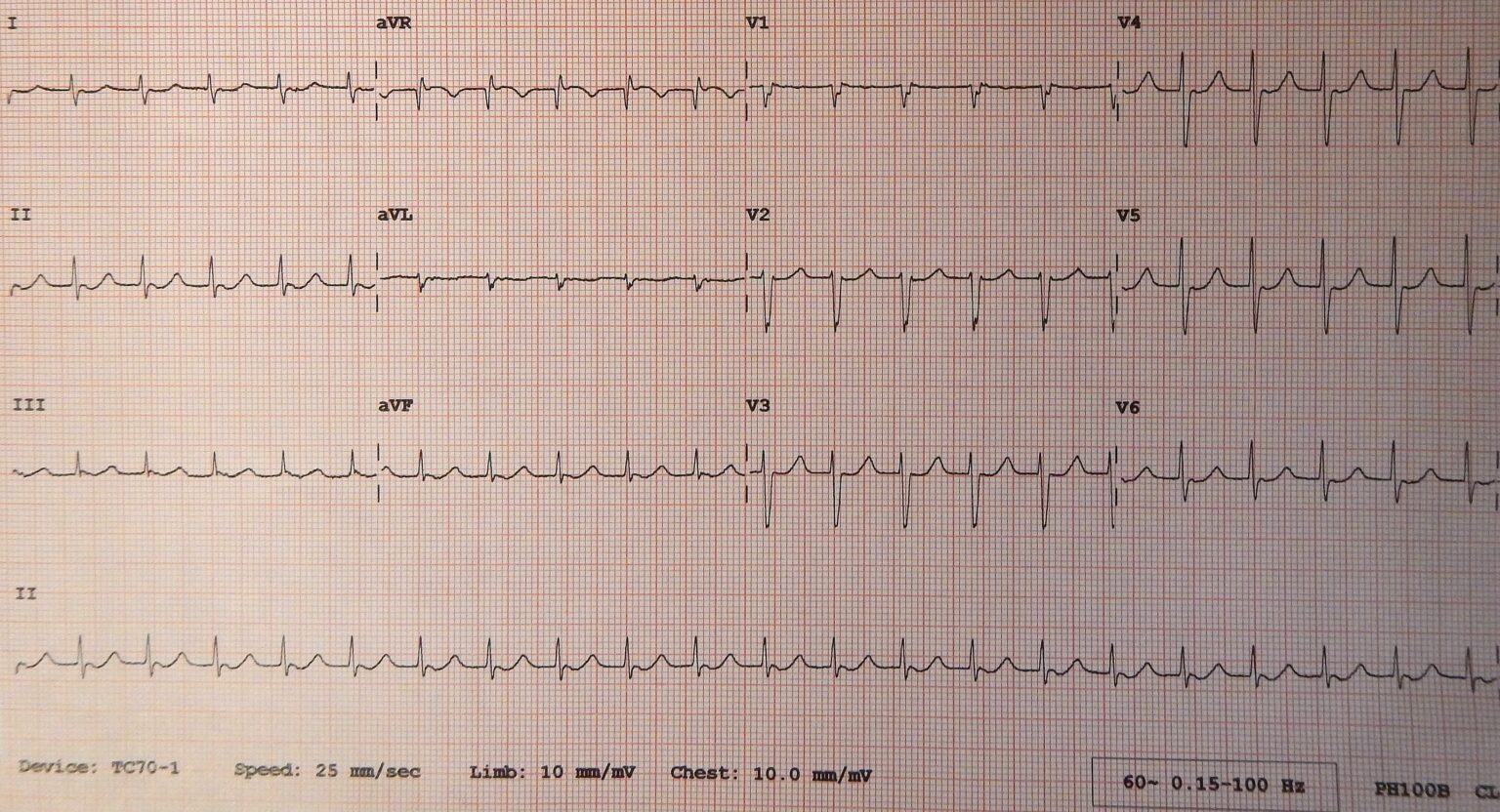 Junctional Tachycardia – ECG Weekly