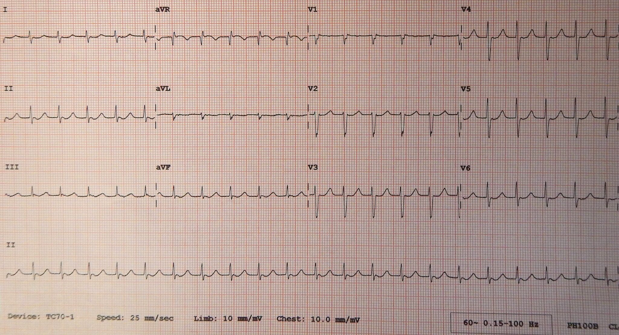 Junctional Tachycardia – ECG Weekly
