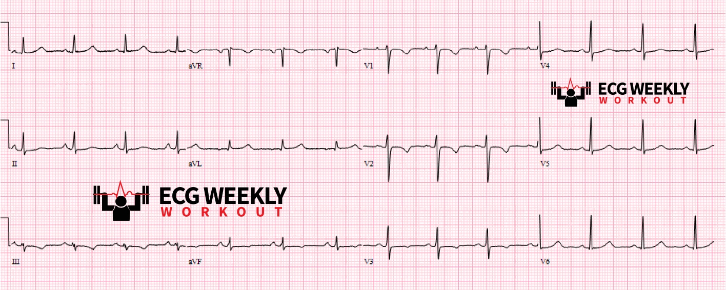Weekly Case – ECG Weekly