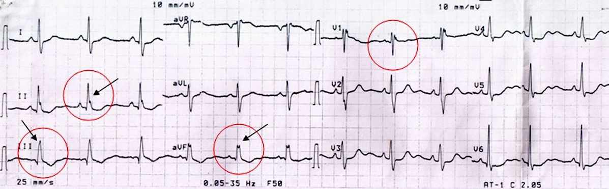 Atrial Septal Defect (ASD) & Crochetage Pattern – ECG Weekly