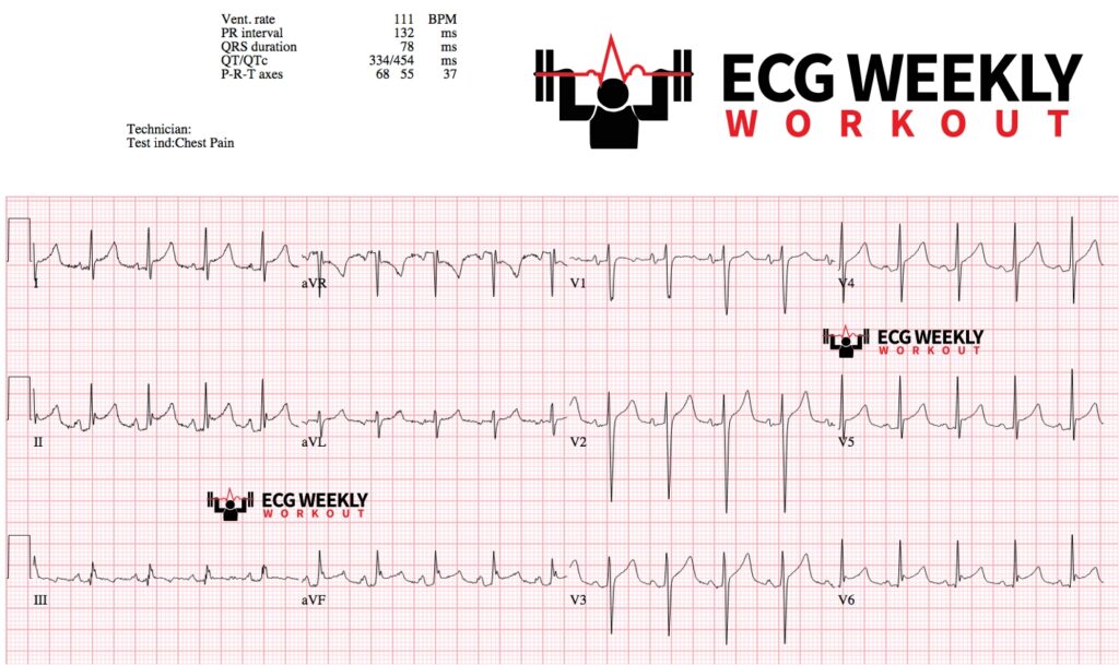 Literature Review: STEMI vs. acute pericarditis – ECG Weekly