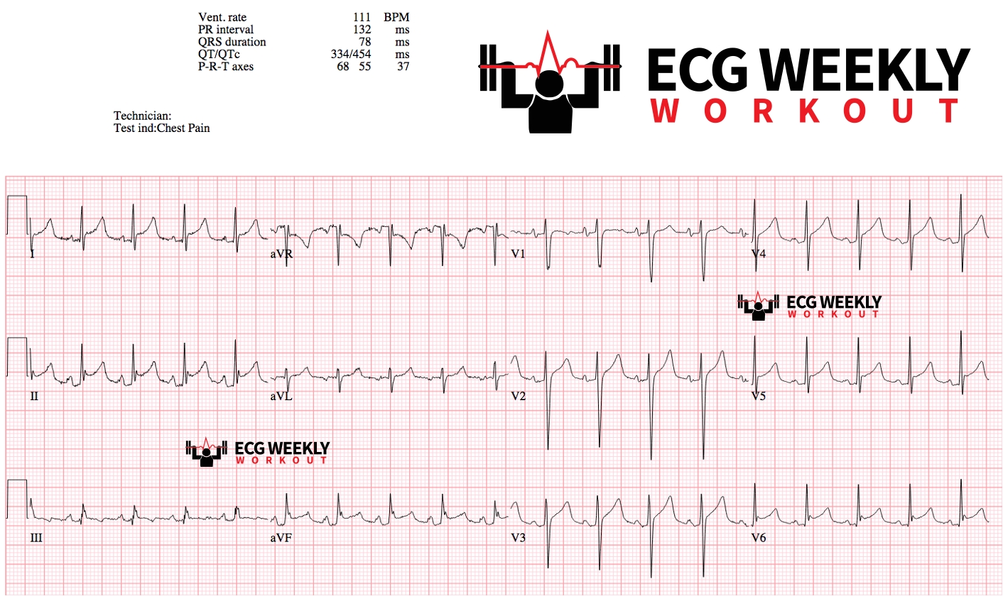 Literature Review: STEMI vs. acute pericarditis – ECG Weekly