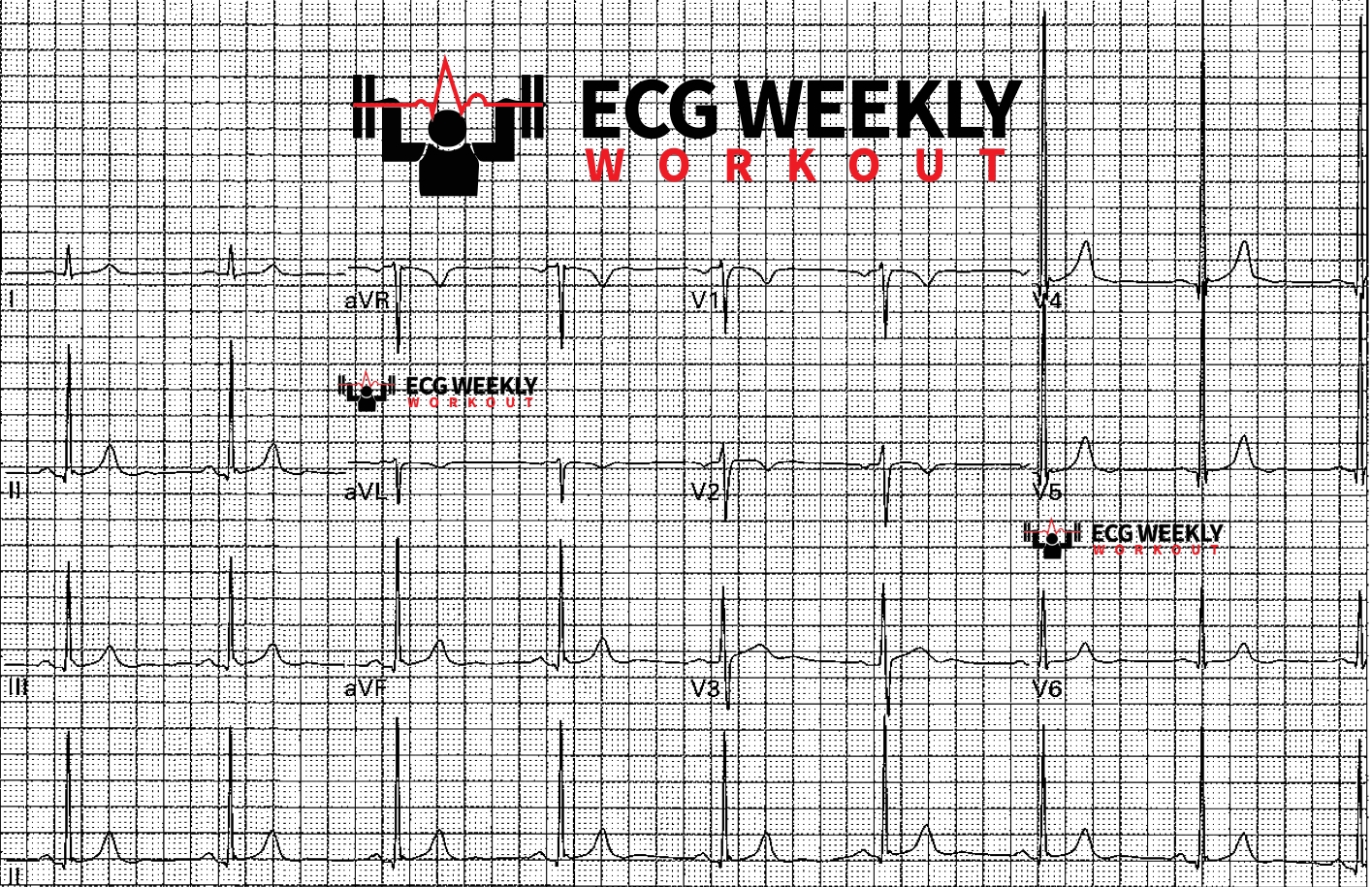 Weekly Case – ECG Weekly