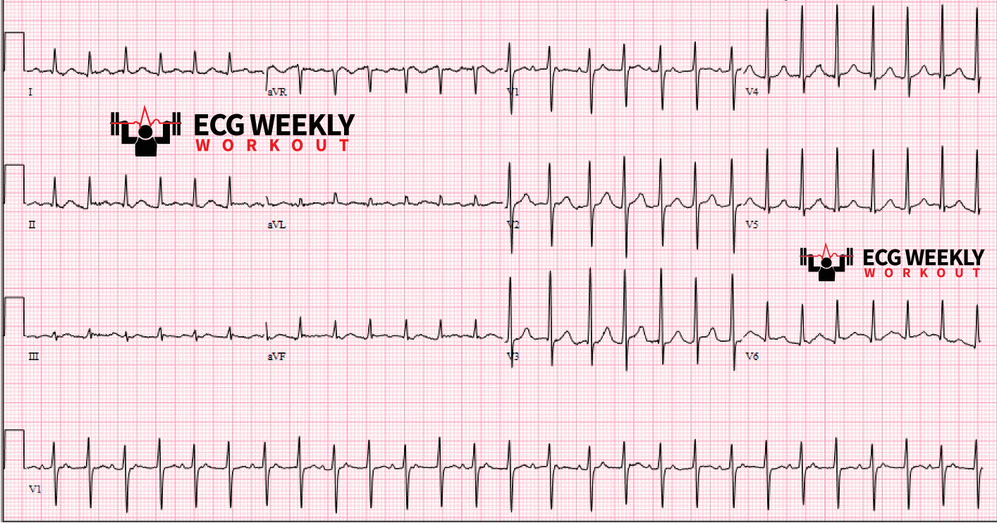 UMEM cases that will teach you how to differentiate narrow complex ...