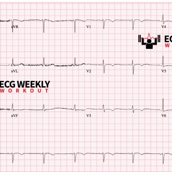 Persistent juvenile T-wave pattern – ECG Weekly