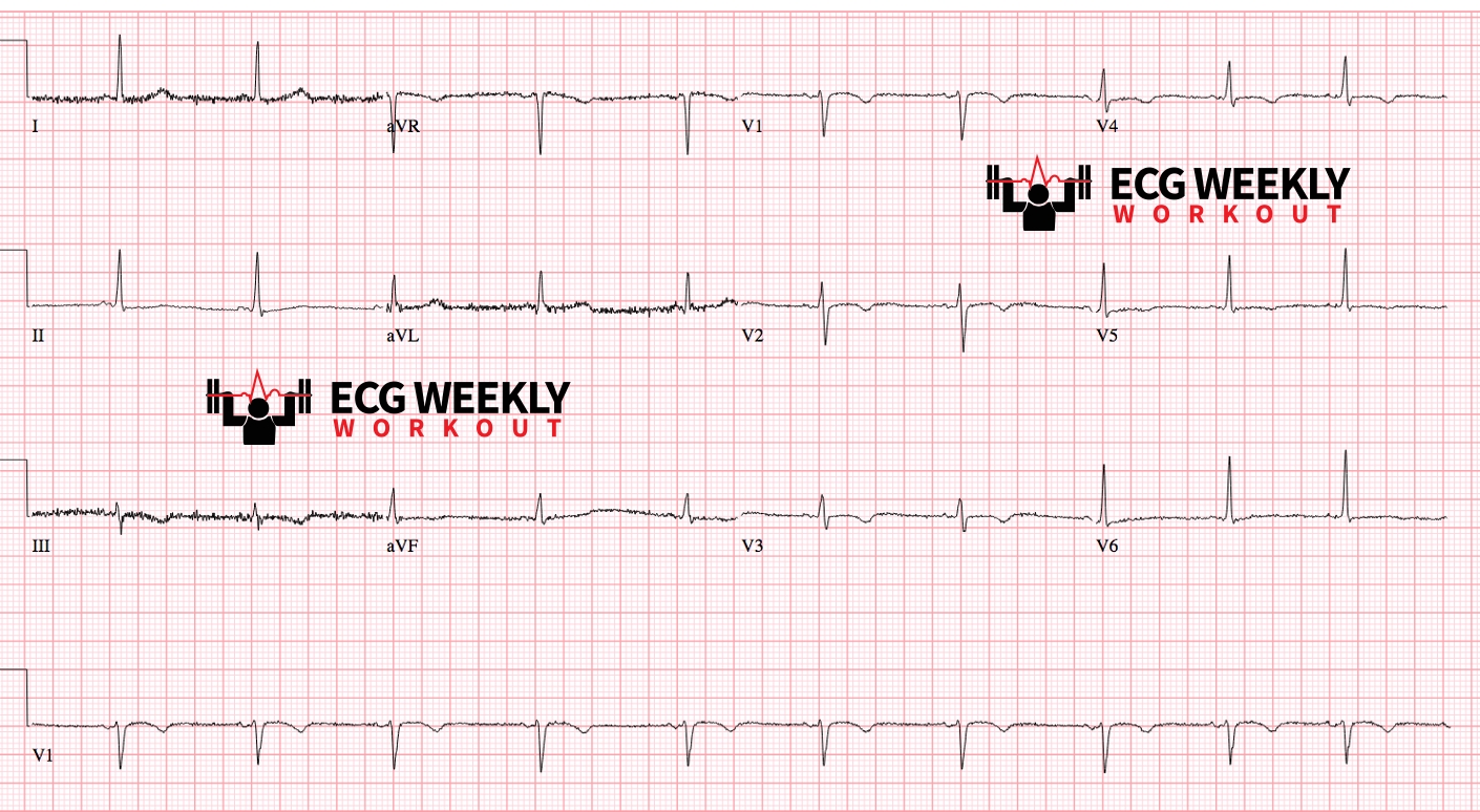 Case-434 – ECG Weekly