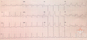ECG Case 3 ECG – ECG Weekly