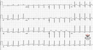 ECG-Case4 – ECG Weekly