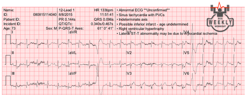 EMS ECGs: common mimics of acute coronary syndrome (ACS) and STEMI ...
