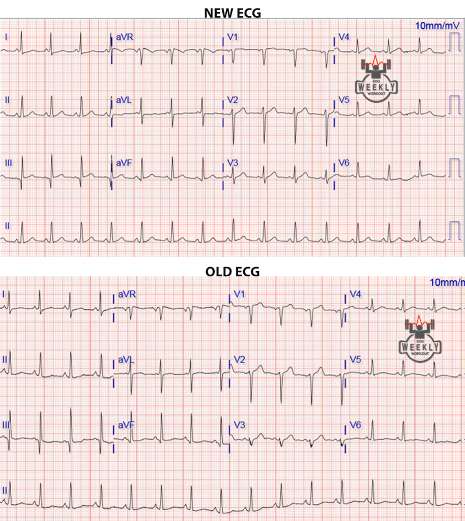 STAT ECG Diagnoses: beware the checkmark sign – ECG Weekly