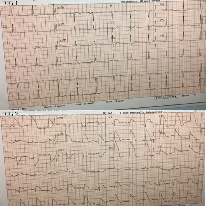 Shark fin morphology – ECG Weekly