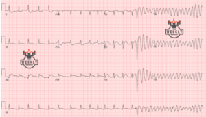 Wide Complex Tachycardias: the three major types of ventricular ...