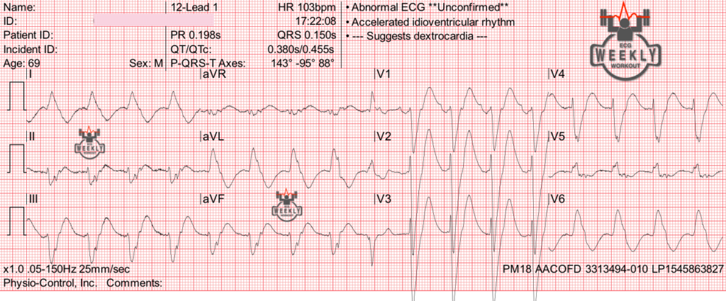 EMS ECGs: accelerated idioventricular rhythm (AIVR) in patients with ...