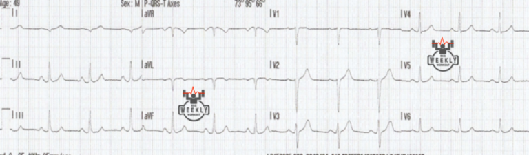 How serial ECGs can save lives! – ECG Weekly