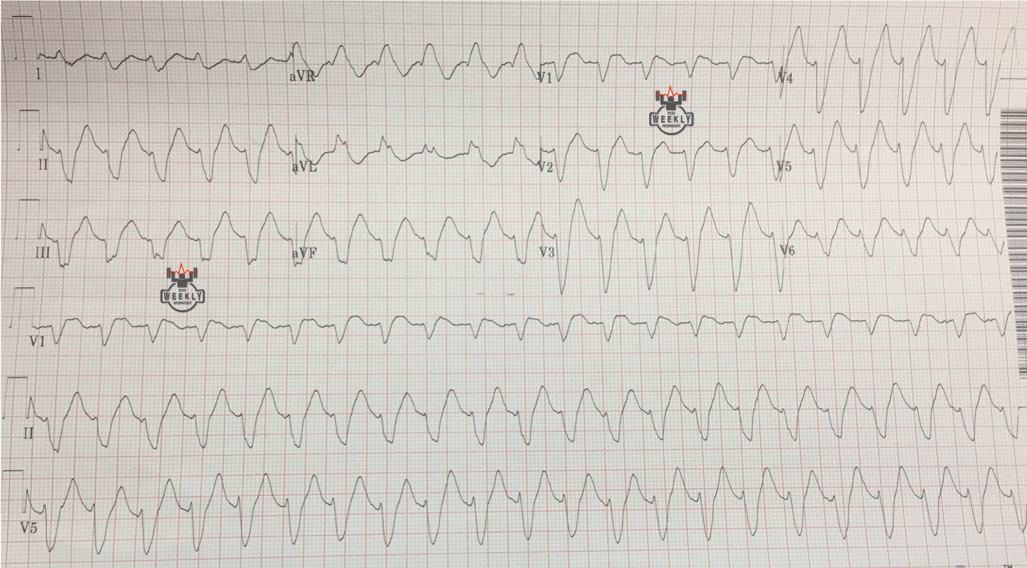 Wide Complex Tachycardias: when suspected ventricular tachycardia is ...