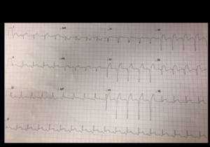 Differential Diagnosis: STEMI vs. acute pericarditis – ECG Weekly