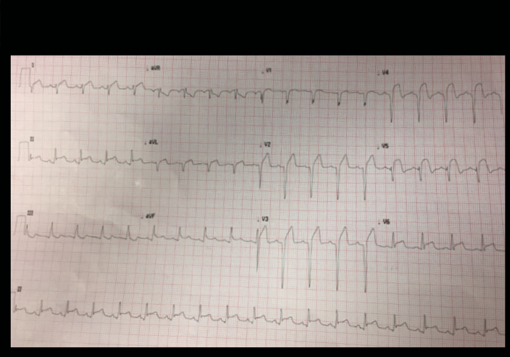 Differential Diagnosis: STEMI vs. acute pericarditis – ECG Weekly