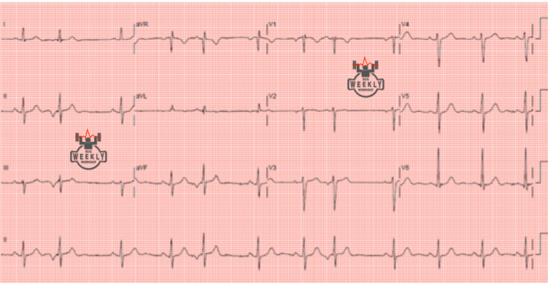 ECG Basics and Fundamentals: does negative troponin ACS still exist ...