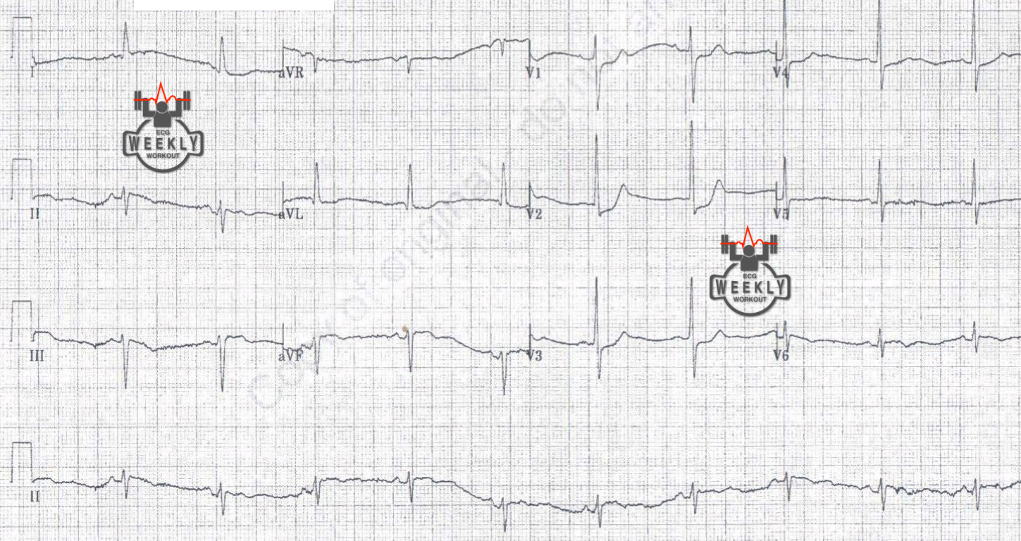Literature Review: 2018 STEMI & STEMI equivalent guideline updates ...